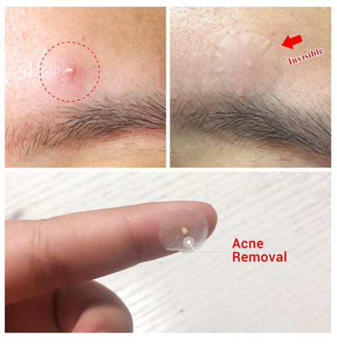 Lanbena Pimple Patch Acne Treatment Patch Acne Stickers Blemish Pimple ...