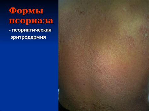 Псориаз - презентация онлайн