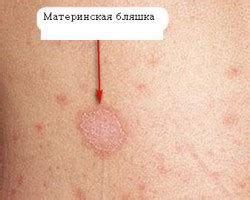 Чем лечить лишай у человека: мазь и препараты для лечения в домашних ...