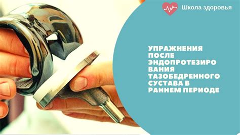 Упражнения после эндопротезирования тазобедренного сустава в раннем ...