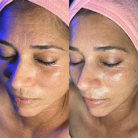 Аппарат Elite Hydrafacial MD