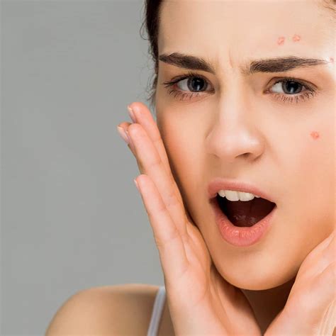Acne Therapy - Evolution Precision Medicine and Aesthetics