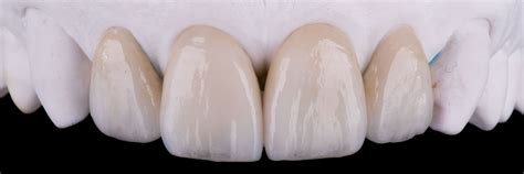Realizzazione corone in ceramica Cantù | Geglio - Laboratorio ...