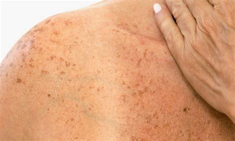 Sun Damaged Skin Treatment Geelong | CRC Geelong