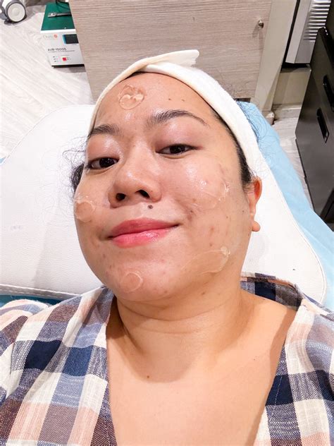 A Review of the Dermadrop Treatment — Project Vanity