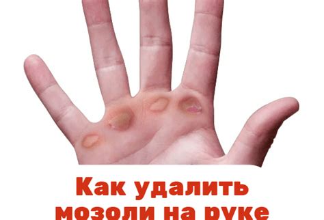 Мозоли на руках: причины, как убрать мозоли на руках