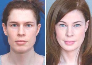 MTF PROCEDURES - Thailand Makeover