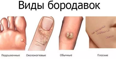 ПРИЧИНЫ ВОЗНИКНОВЕНИЯ И МЕТОДЫ ИЗБАВЛЕНИЯ ОТ БОРОДАВОК — МедВестник