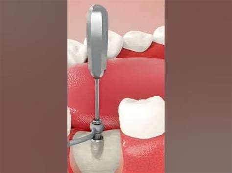 Що таке #імплант? 🦷 #зуби #стоматологія #стоматологкиїв #брекети # ...