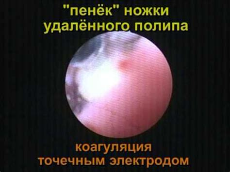Полип шейки матки. Удаление без боли и без наркоза. - YouTube