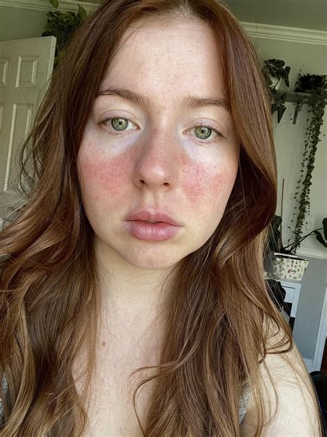 Azelaic Acid - Gel vs Cream? : r/Rosacea
