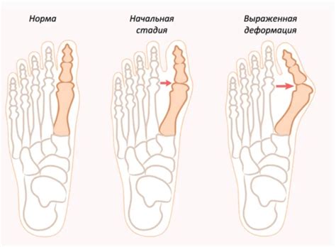Операция по удалению косточки на большом пальце ноги в Красноярске ...