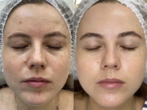 PRX-T33 Biorevitalization Peel PHX | Suddenly Slimmer Med Spa Phoenix