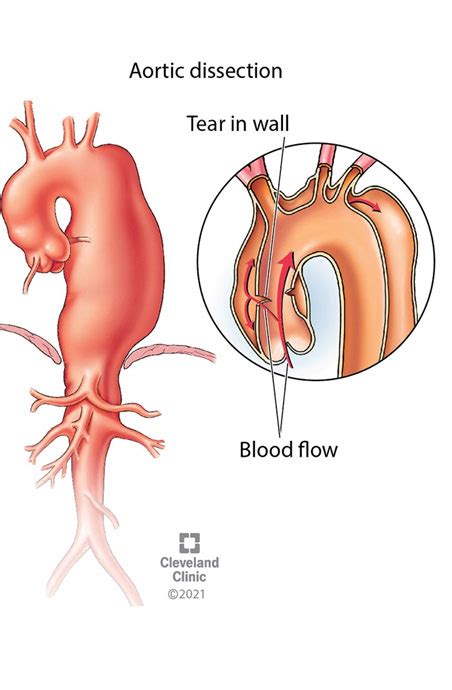 Cardiac Care Advanced Aortic Surgery & Vascular Solutions