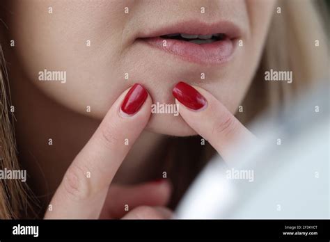 Young woman squeezing out pimple with her hands closeup Stock Photo - Alamy