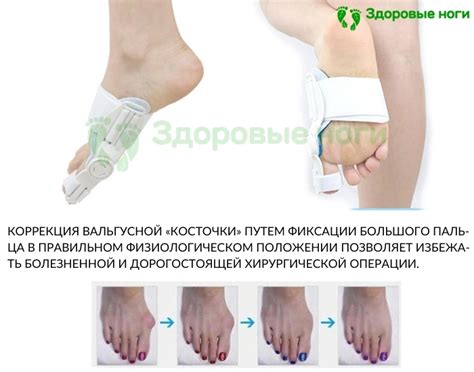 Вальгусная шарнирная шина с защитным лепестком - купить ортопедический ...