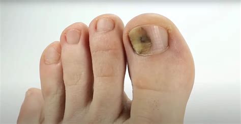 Best Fungal Nail Treatment: Read More