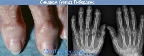 Первичный хронический полиартрит пальцев кисти. Узлы Гебердена