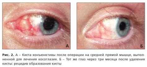 Киста на глазу: виды, симптомы, методы лечения и чем опасно заболевание