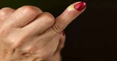 Pus formation – expert tips for home treatment | TheHealthSite.com