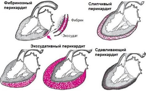 Перикардит: симптомы и лечение у взрослых