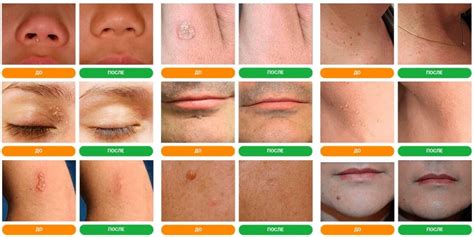 Papiderm zur Entfernung von Papillomen und Behandlung von HPV [Preis ...