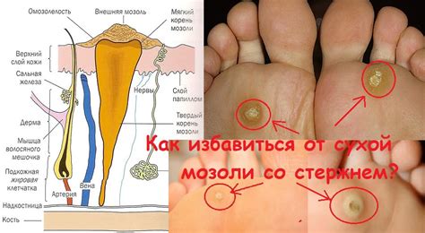 Бородавки на ступнях: лечение и быстрое избавление от натоптышей на ...