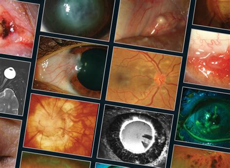 The Review of Optometry Photo Atlas of Ocular Disease