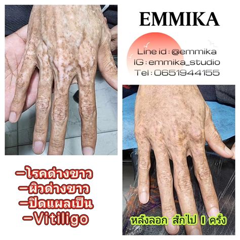 Emmika... - Emmika ร้านสักเอมมิกา ต่อขนตาพรีเมี่ยม ลบรอยสัก