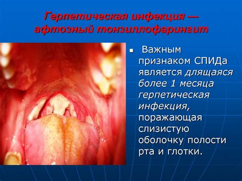 Поражение ЛОР-органов при ВИЧ-инфекции - презентация онлайн