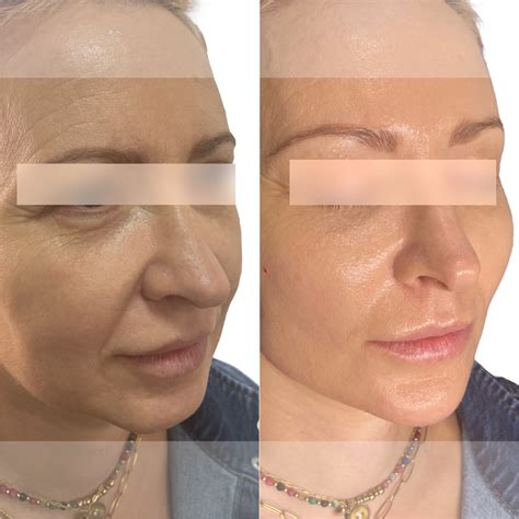 #FULLFACE - д-р Керимов - Естетична клиника