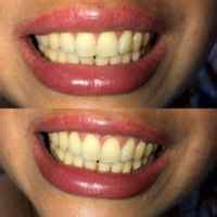 Отбеливающий карандаш для зубов Dazzling White Teeth Whitening Pen | отзывы
