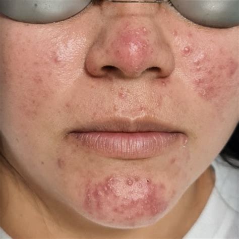 Treatment for active acne - Balancemedspa.com