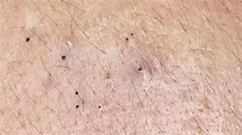 The whole story behind a huge blackhead removal