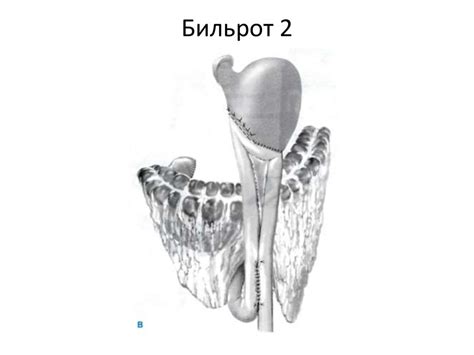 Резекция желудка по способу Бильрот 1 - презентация онлайн
