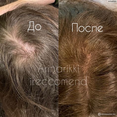 Лосьон для волос DSD de Luxe Капиксил № 3.4.4 (CAPIXYL + PLACENTA SHOCK ...