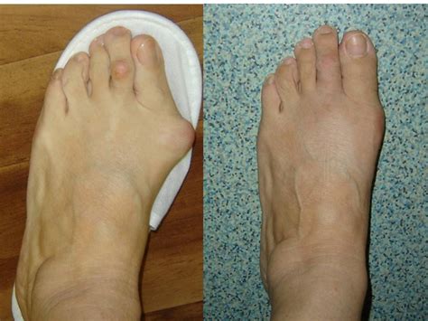 Cum se folosesc ceapa si prazul pentru a scapa de monturi | Skin spots ...