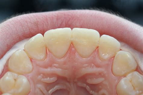 Вантовое шинирование зубов в Киеве 🦷 Шинирование в клинике ЦИС | CIS