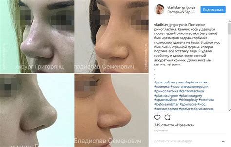 Неудачная ринопластика носа. Фото до и после.