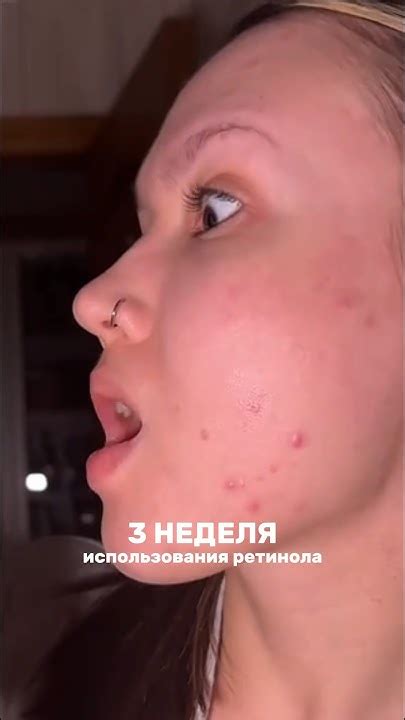 РЕТИНОЛ СПАС ОТ ПРЫЩЕЙ😱 мой ретинол: 142054897 #акне #прыщи #ретинол ...
