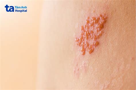 Zona thần kinh: Nguyên nhân, triệu chứng và phòng ngừa