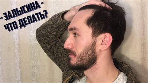 Залысина. Можно ли зарастить? - YouTube