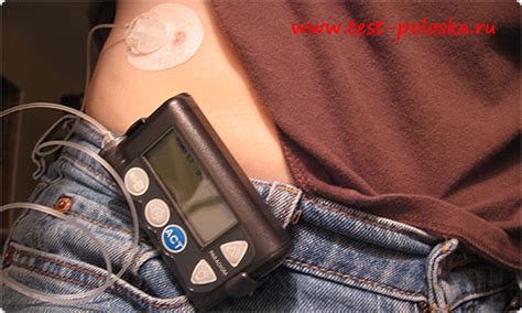 Инсулиновые помпы Medtronic на пробный период