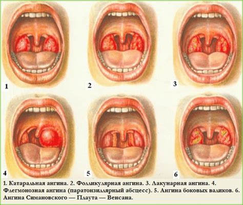Как распознать признаки ангины у вашего малыша? Подробная информация и ...