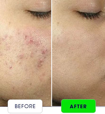 Mandelac Serum 20% - Price, Uses, Review of Mandelic Acid - JenPharm ...