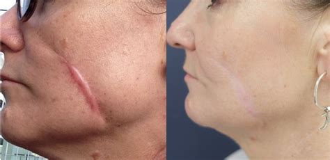 Scar Treatment in London - Dr Firas Al-Niaimi | London Dermatologist