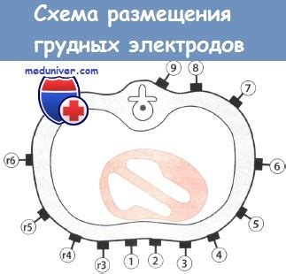 Грудные отведения ЭКГ - наложение электродов, оценка