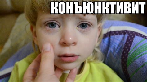 КОНЪЮНКТИВИТ У РЕБЕНКА? Как и чем промывать глаза у детей при ...