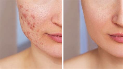 Adult acne: Dermatologists explain acne treatments and reveal more ...