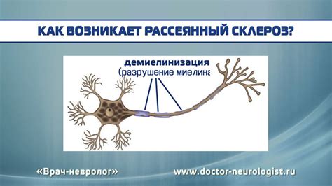 Рассеянный склероз: причины возникновения, клинические признаки - YouTube